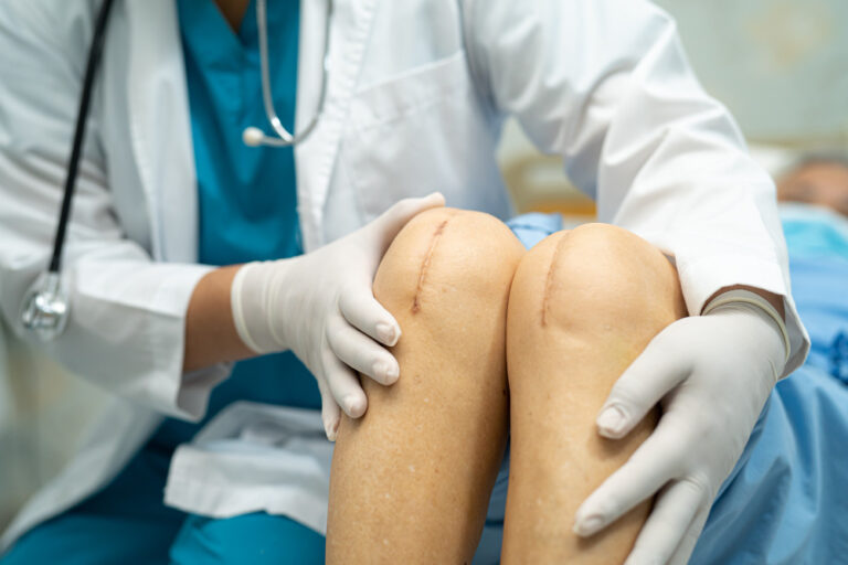 Recovering from Knee Replacement Surgery | DocTrePat